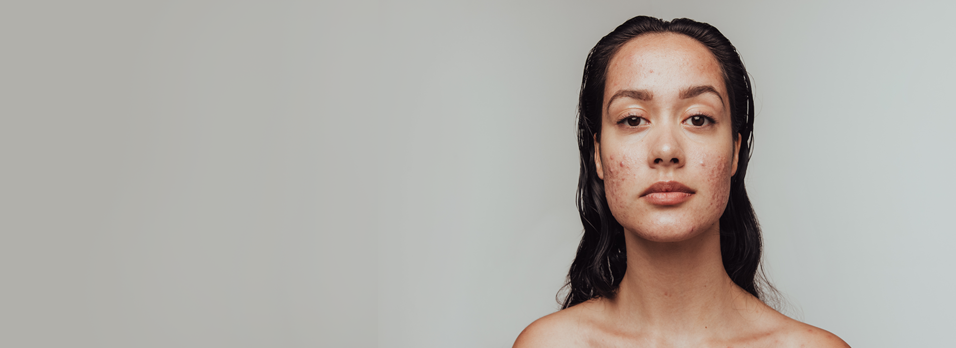 Hirsutismus und Akne beim Polycystischen Ovarialsyndrom - Exeltis GmbH